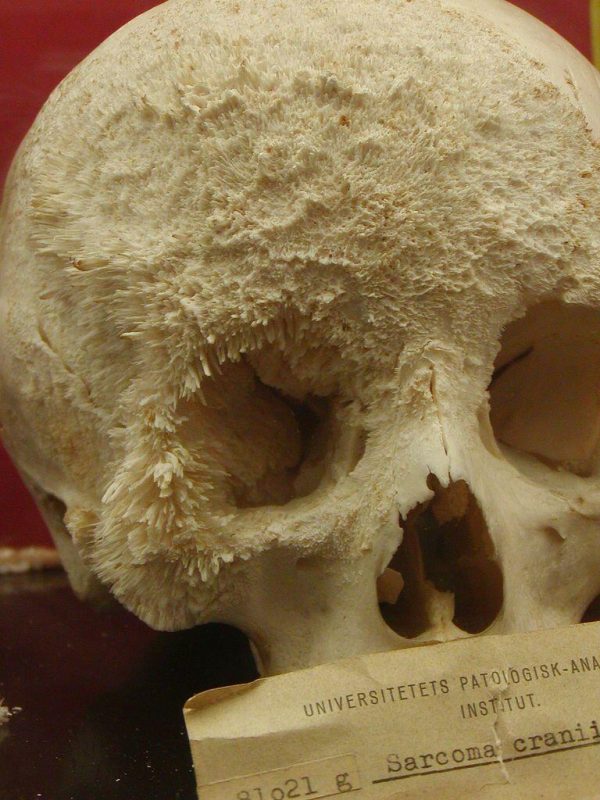 Bone Pathology: A Look at Osteosarcoma of the Skull - The Rockstar ...
